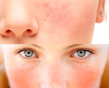 Rosácea: Causas, Síntomas, Tratamiento Y 6 Formas Naturales Para ...