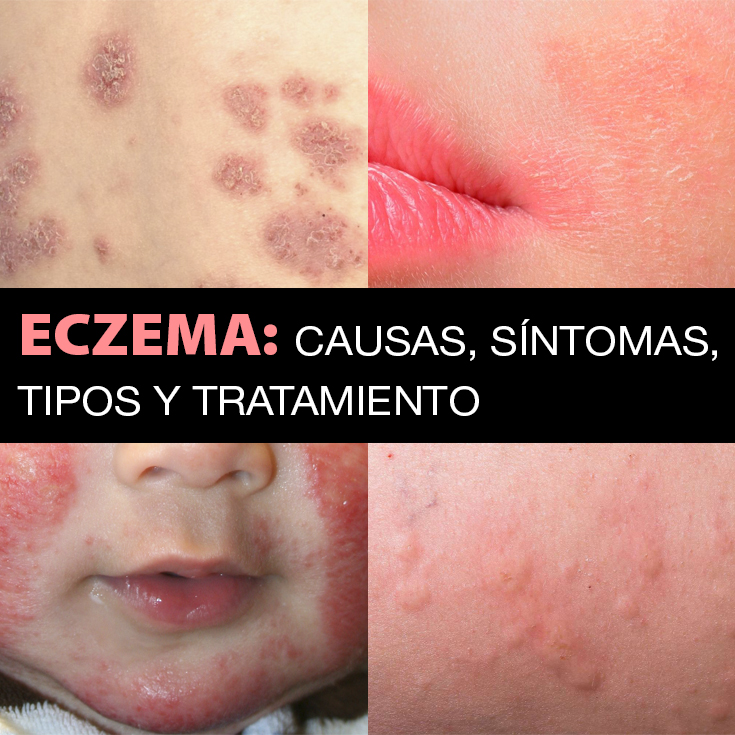 Eczema: causas, tipos, síntomas y tratamiento - La Guía de las Vitaminas